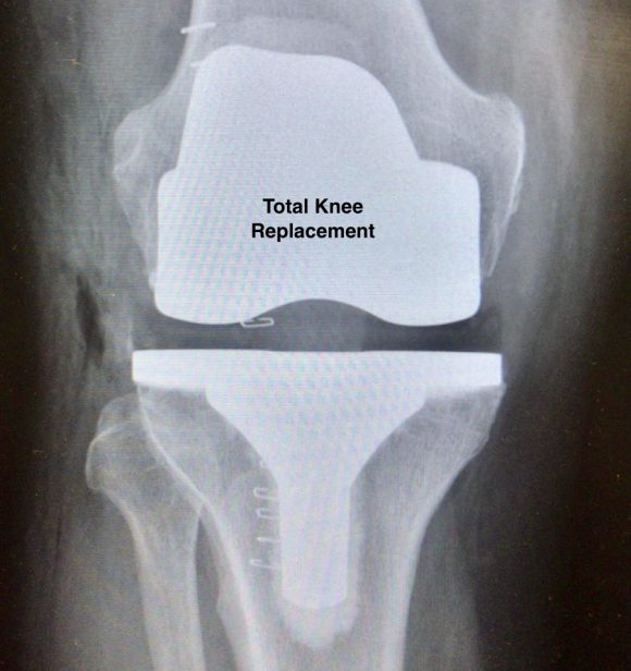 Computer Assisted Knee Replacement – ayazlakdawala